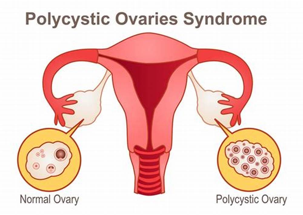Polycystic ovary syndrome (PCOS) | V.L. Makabali Memorial Hospital, Inc.