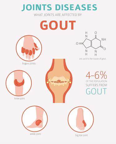 Gout (Inflammatory arthritis) | V.L. Makabali Memorial Hospital, Inc.