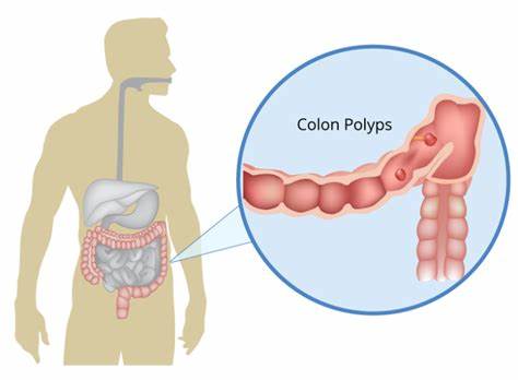 Colon polyps | V.L. Makabali Memorial Hospital, Inc.