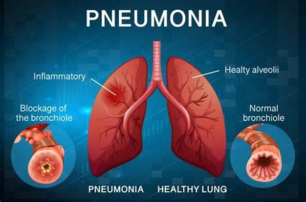 What is Pneumonia? | V.L. Makabali Memorial Hospital, Inc.